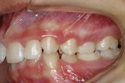 RETRUDED MANDIBLE - Clínica Dental Ortigosa