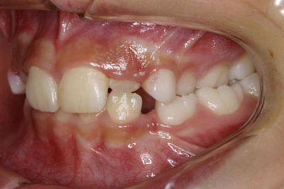 Paladar estrecho - Clínica Dental Ortigosa