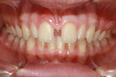 MANDIBULAR RETROGNATHIA AND INTERINCISAL GAP - Clínica Dental Ortigosa
