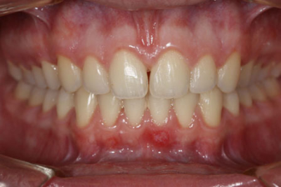 Retrognatia mandibular y diastema - Clínica Dental Ortigosa