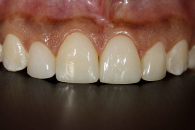 ERODED ENAMEL - Clínica Dental Ortigosa