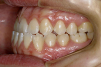 Prognatismo Mandibular - Clínica Dental Ortigosa